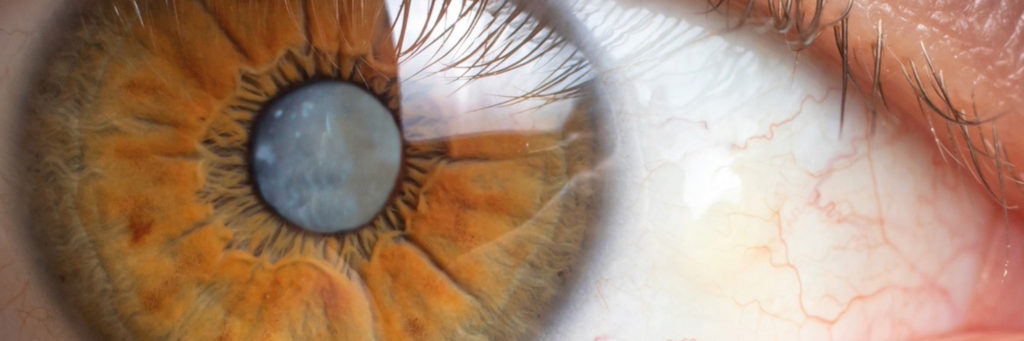 Katarakt Operation - Augenzentrum Leopoldstadt